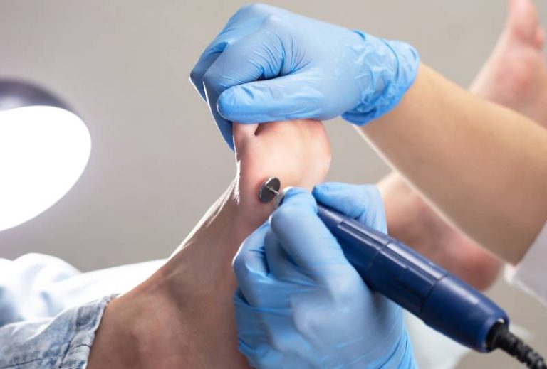 Corns & Calluses | Innovation Medical Group